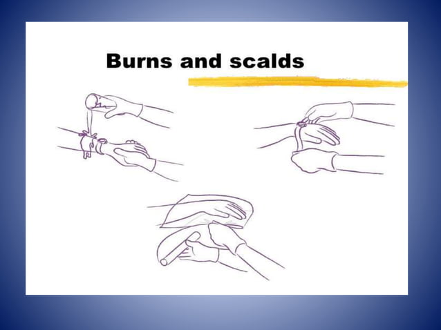 First aid in burns and scalds | PPTX