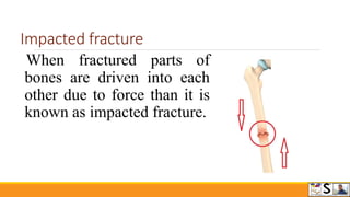 First aid in fracture in ENGLISH | PPTX