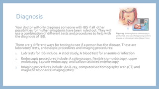 First inflammatory bowel disease presentation finished version (2) | PPT