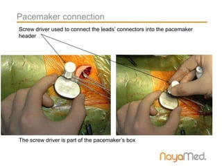 First Naya Med Implant | PPSX