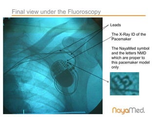 First Naya Med Implant | PPSX