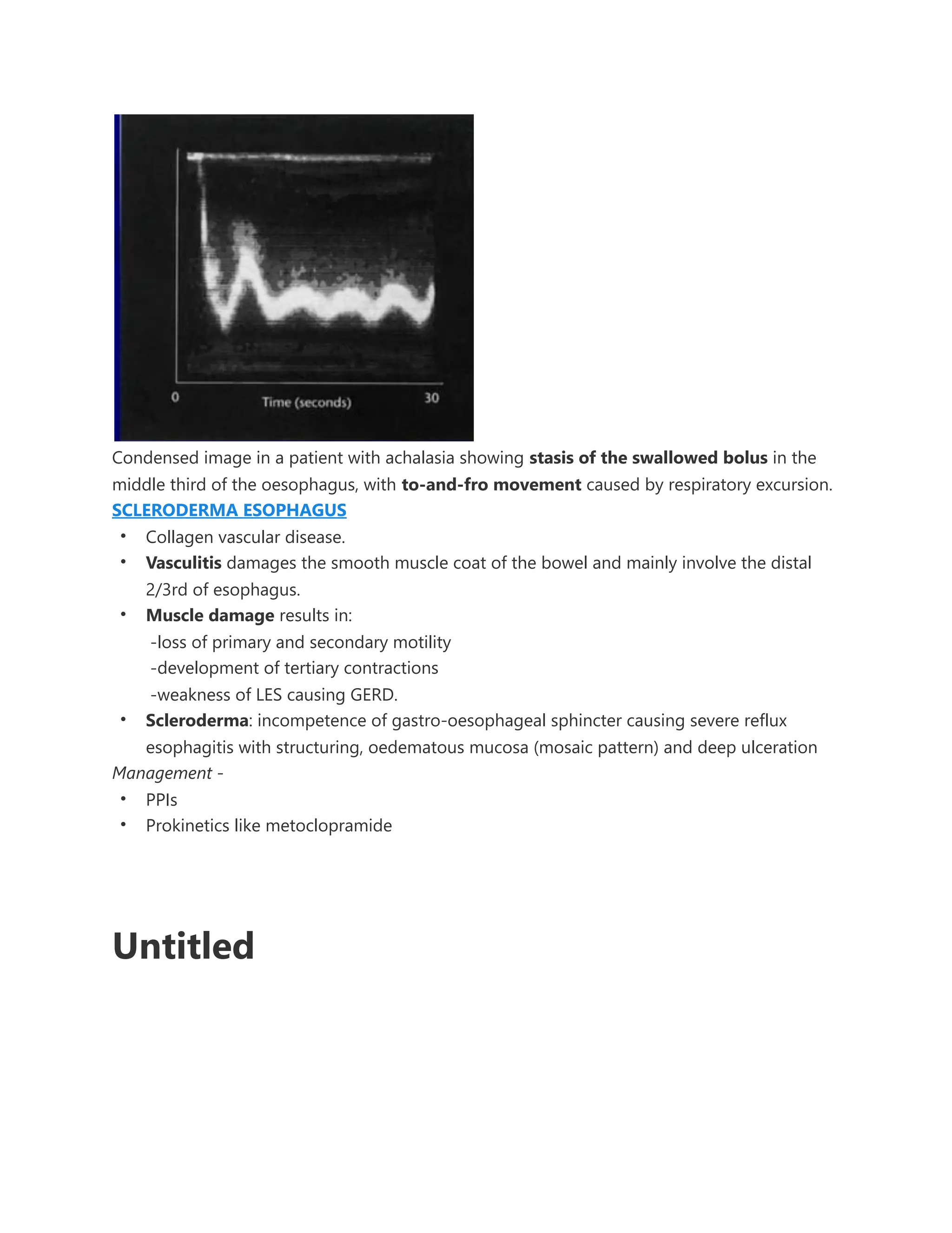Esophageal motility disorders with their description | PDF