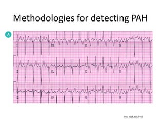Pulmonary arterial hypertension in rheumatic diseases | PPT