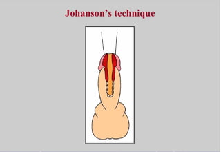 First stage of johanson procedures | PPT