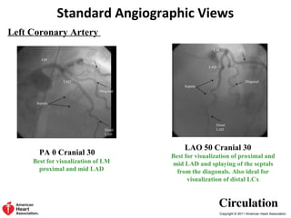 First step of coronary angiography | PPT