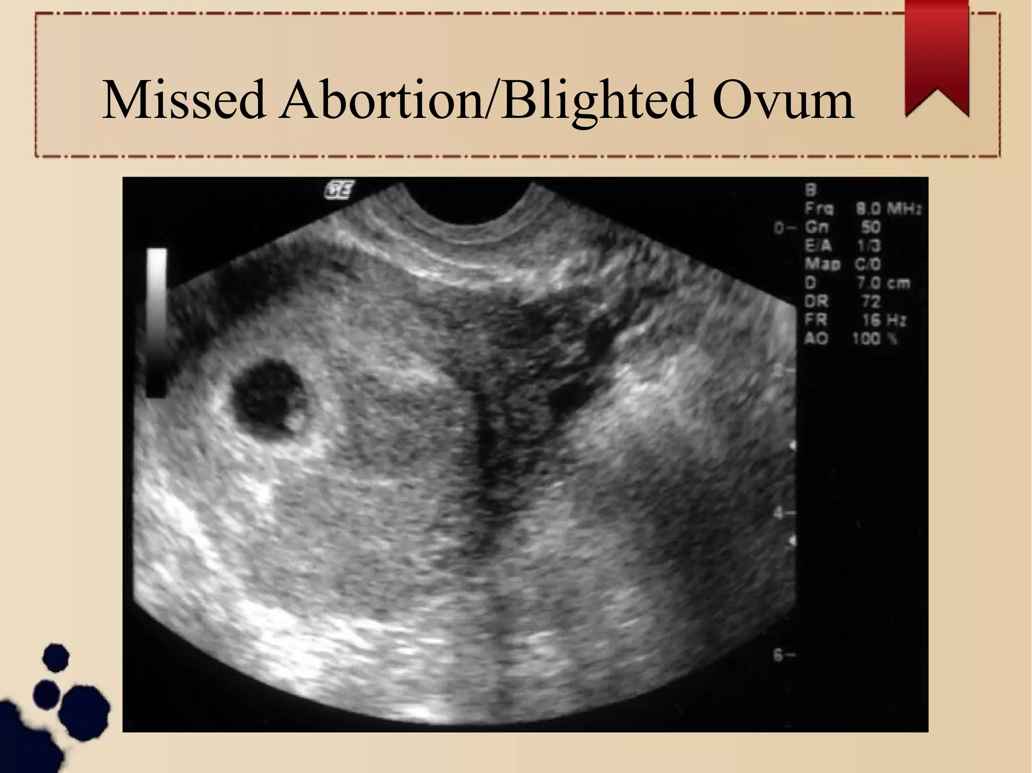 First trimester bleeding | PPT | Pregnancy | Reproductive Health