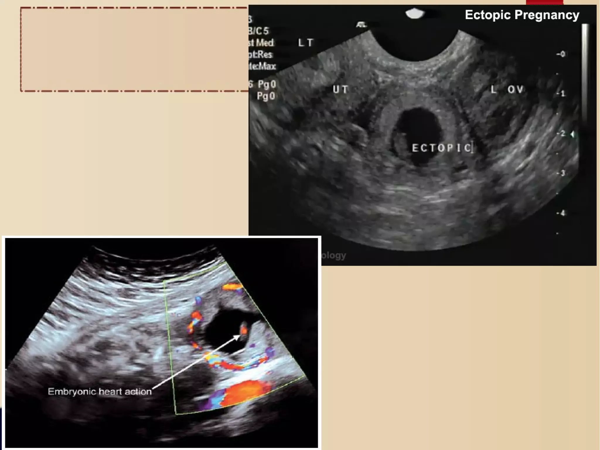 First trimester bleeding | PPT | Pregnancy | Reproductive Health
