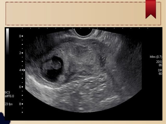 First trimester bleeding | PPT | Pregnancy | Reproductive Health