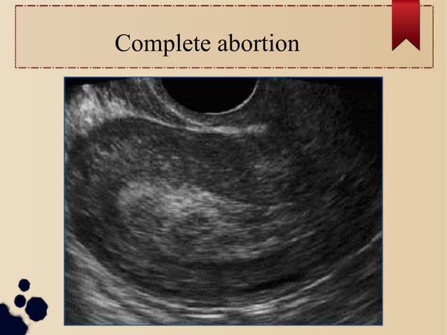 First trimester bleeding | PPT | Pregnancy | Reproductive Health