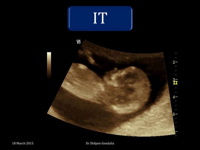 First trimester scan | PPTX