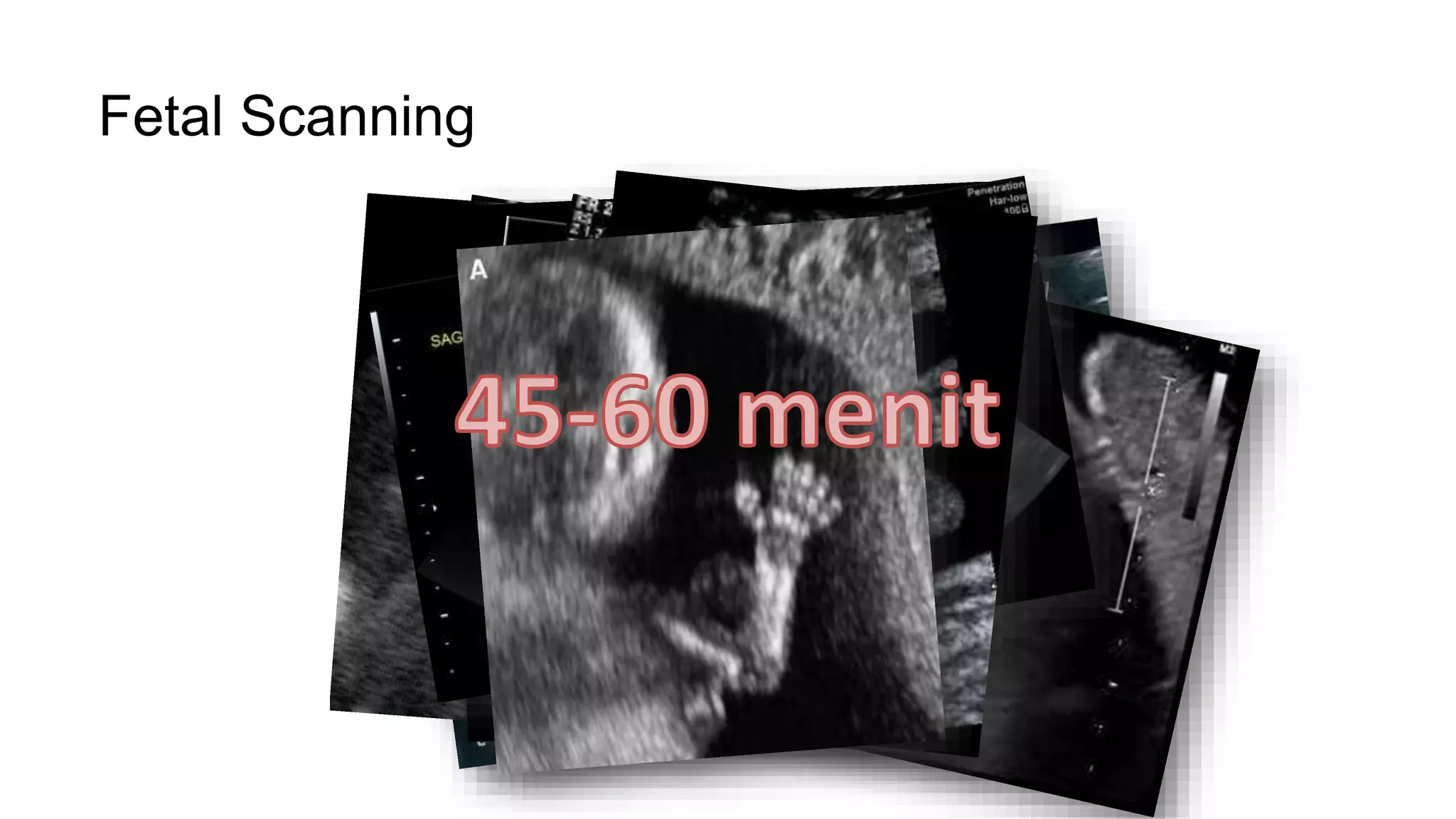 First trimester screening for fetal abnormalities | PPTX