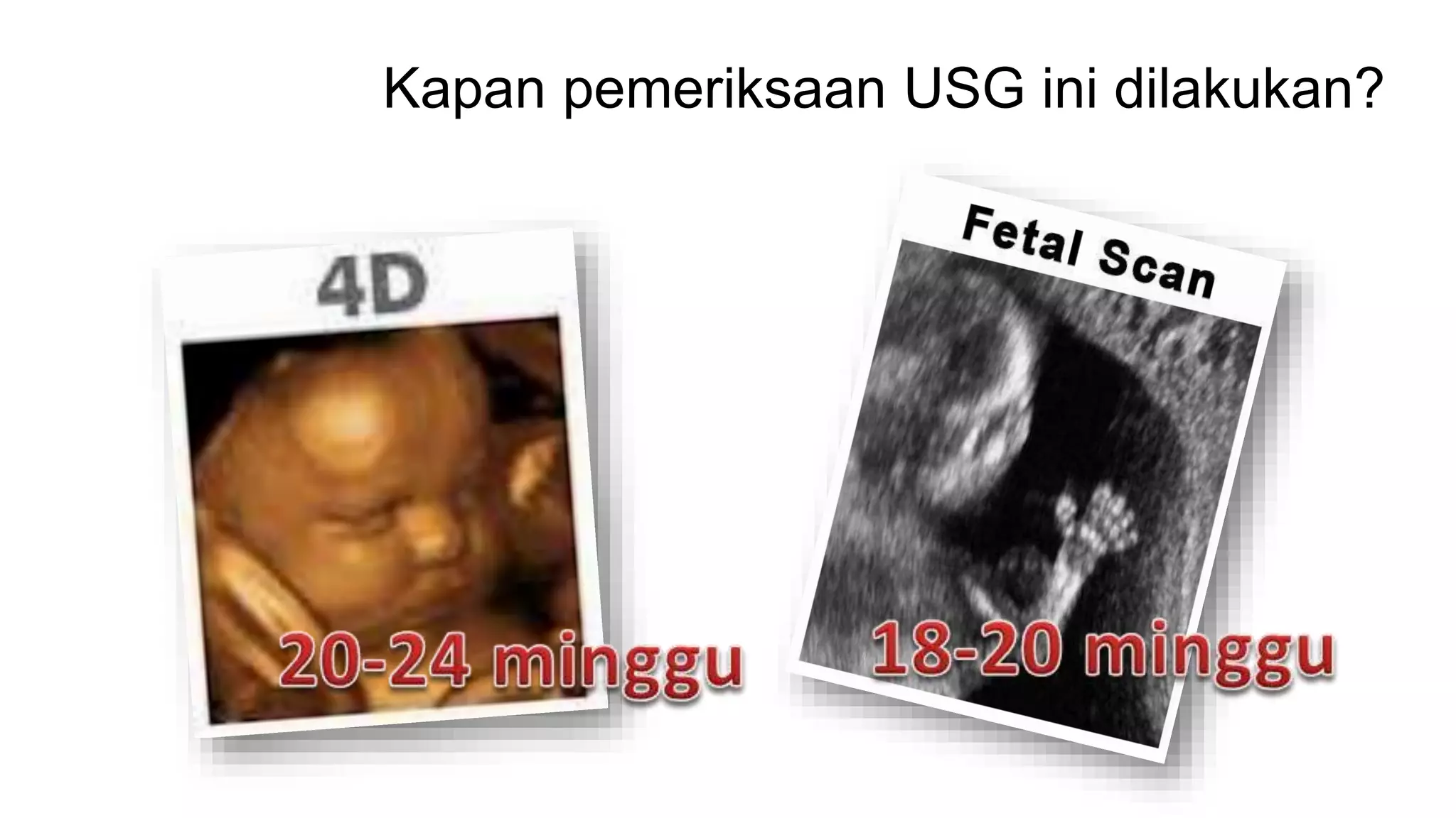 First trimester screening for fetal abnormalities | PPTX