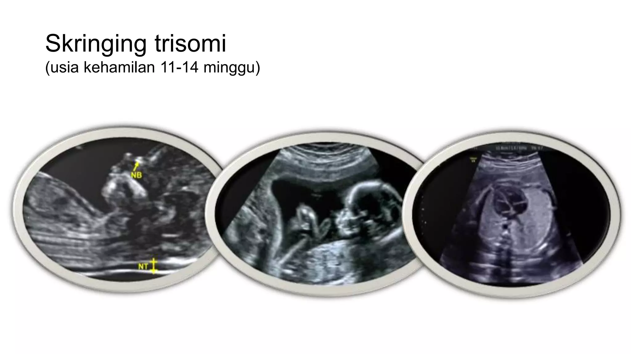 First trimester screening for fetal abnormalities | PPTX