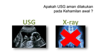 First trimester screening for fetal abnormalities | PPTX