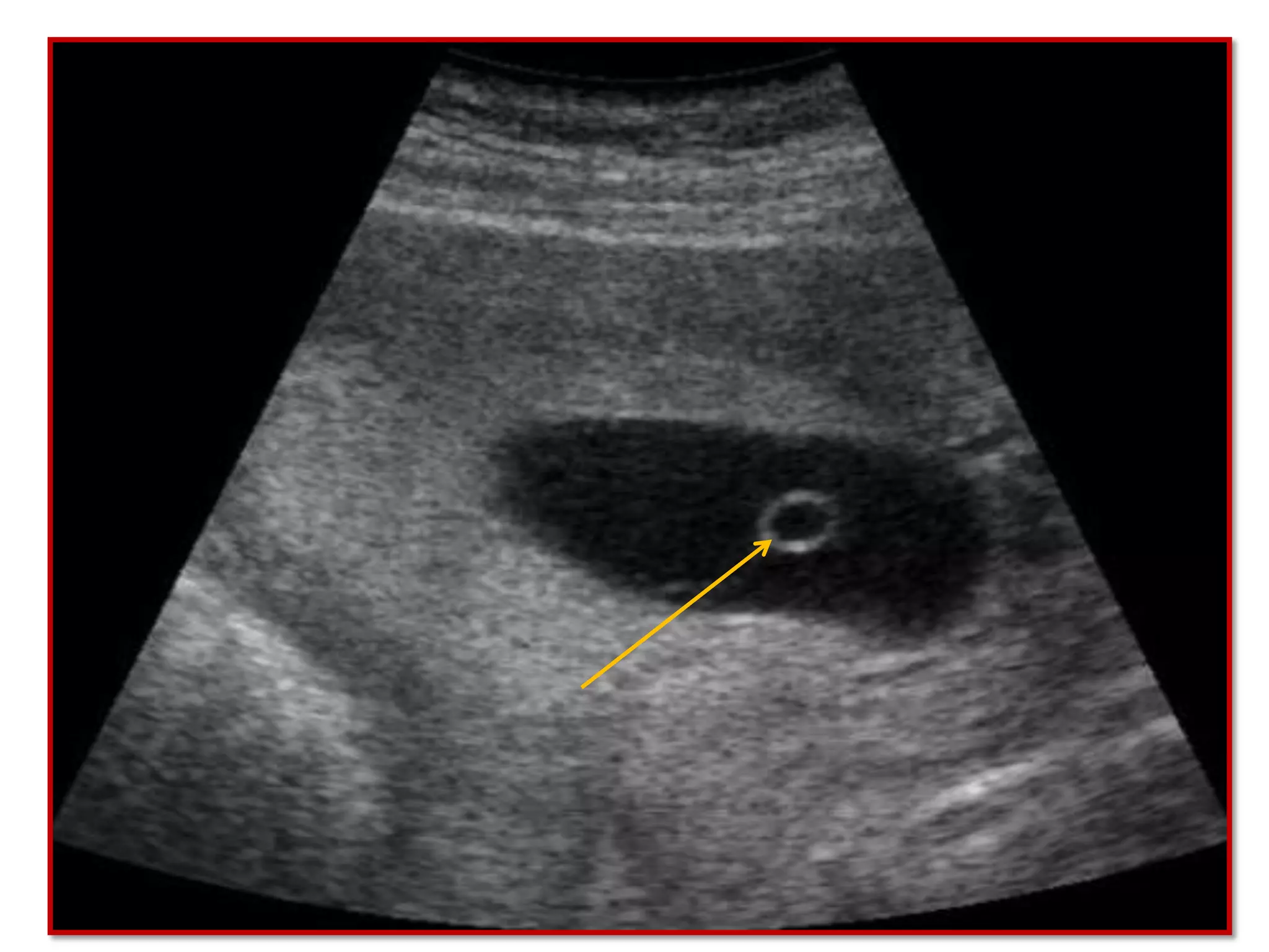 First trimester ultrasound | PDF