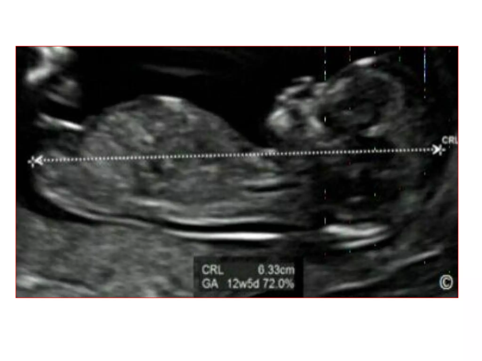 First trimester ultrasound | PDF