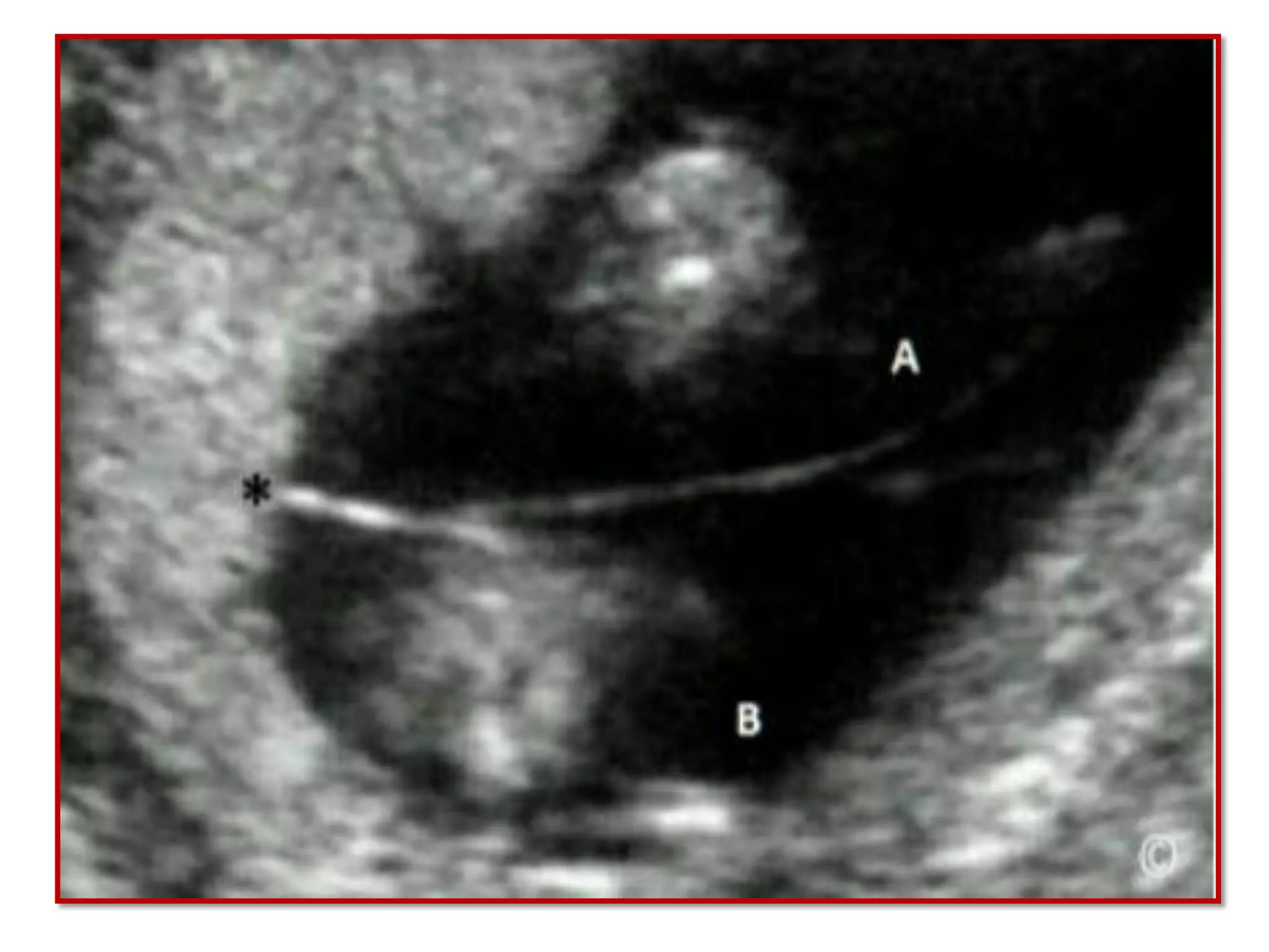 First trimester ultrasound | PDF