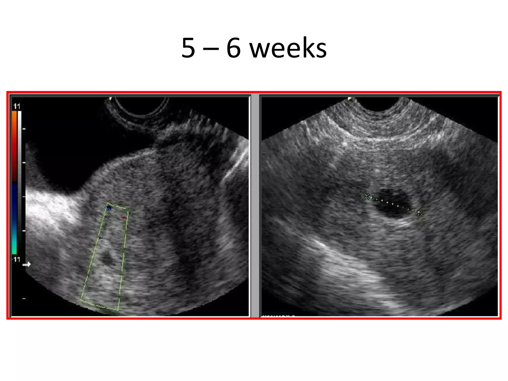First trimester ultrasound | PDF