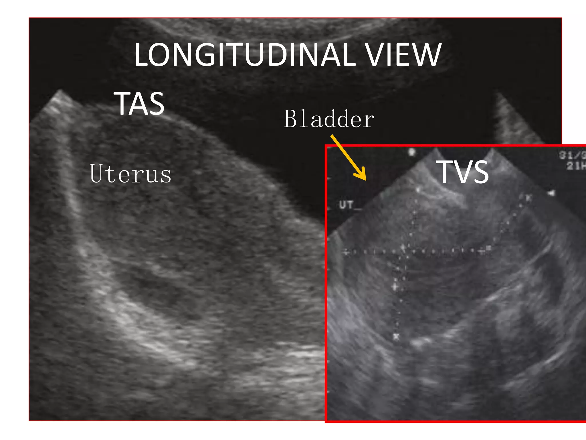 First trimester ultrasound | PDF