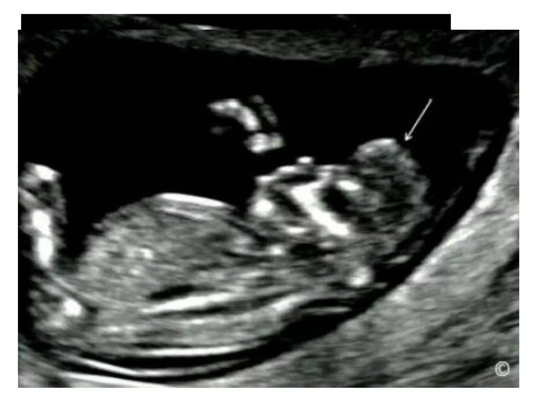 First trimester ultrasound | PDF