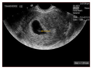 First trimester ultrasound | PDF