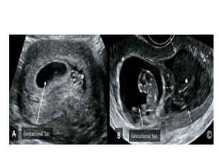 First trimester ultrasound | PDF