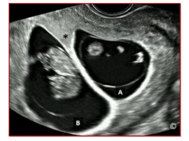 First trimester ultrasound