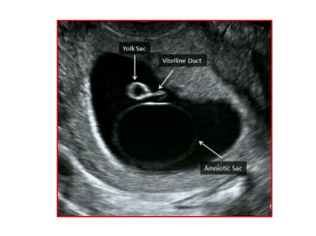 First trimester ultrasound