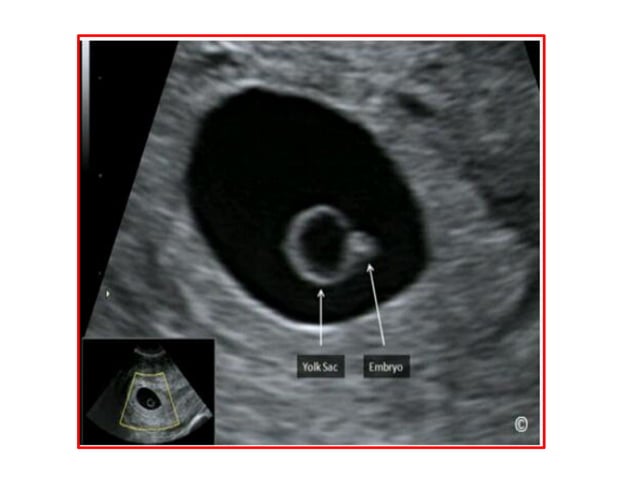 First trimester ultrasound