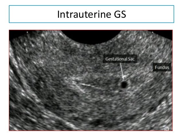 First trimester ultrasound