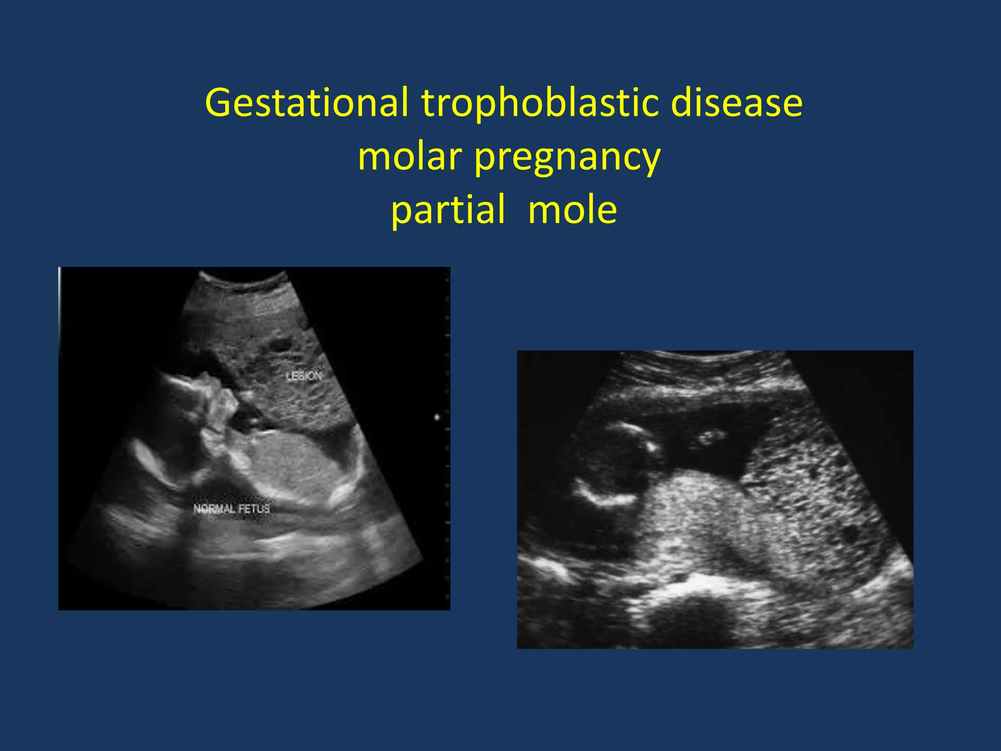 First trimester ultrasound | PPTX