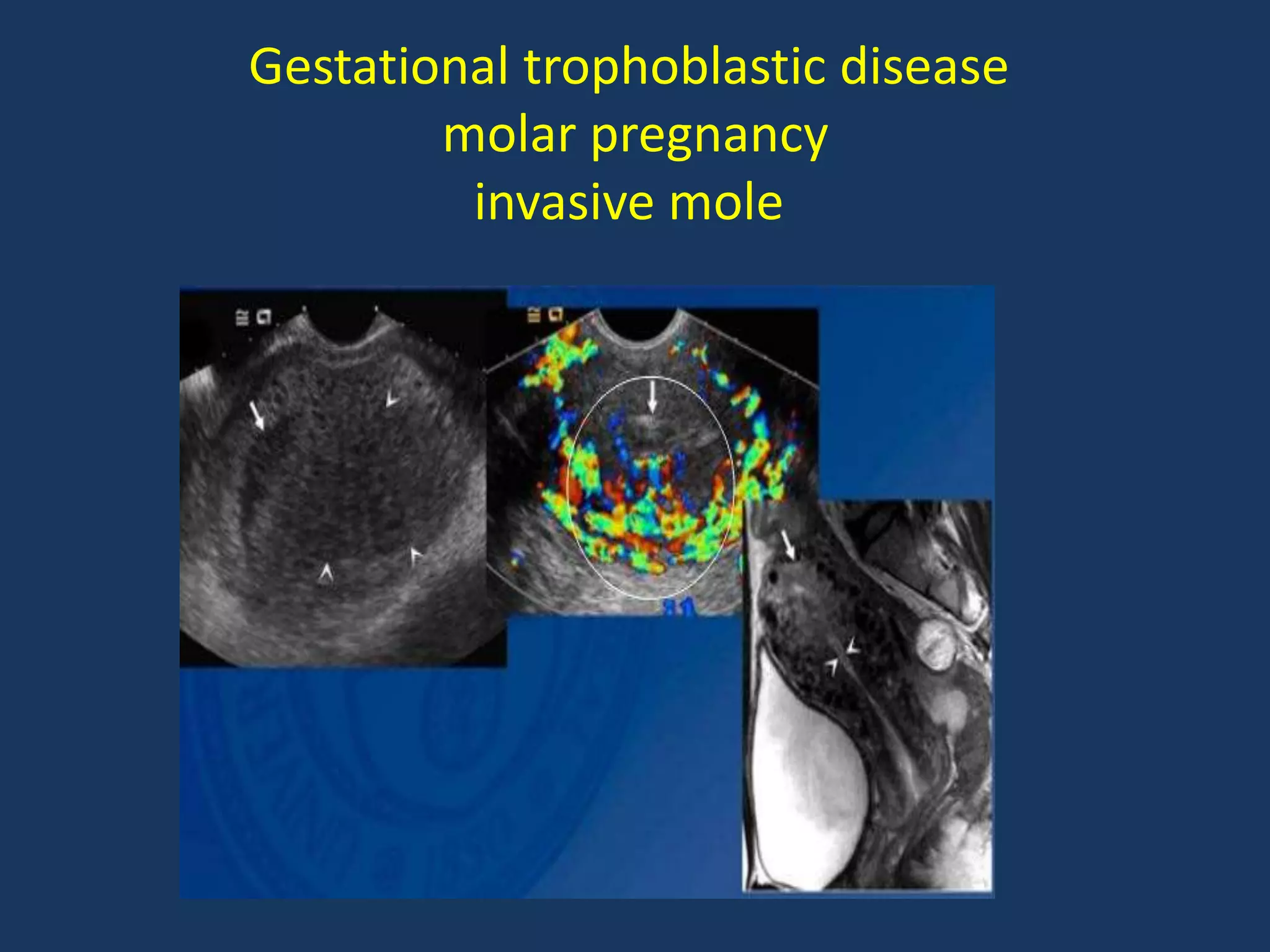 First trimester ultrasound | PPTX
