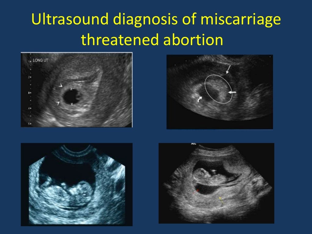 First Trimester Ultrasound