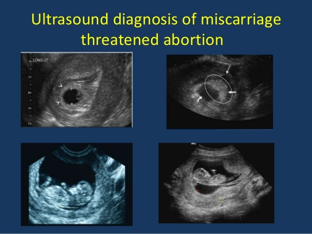 First trimester ultrasound
