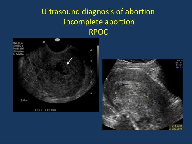 First trimester ultrasound