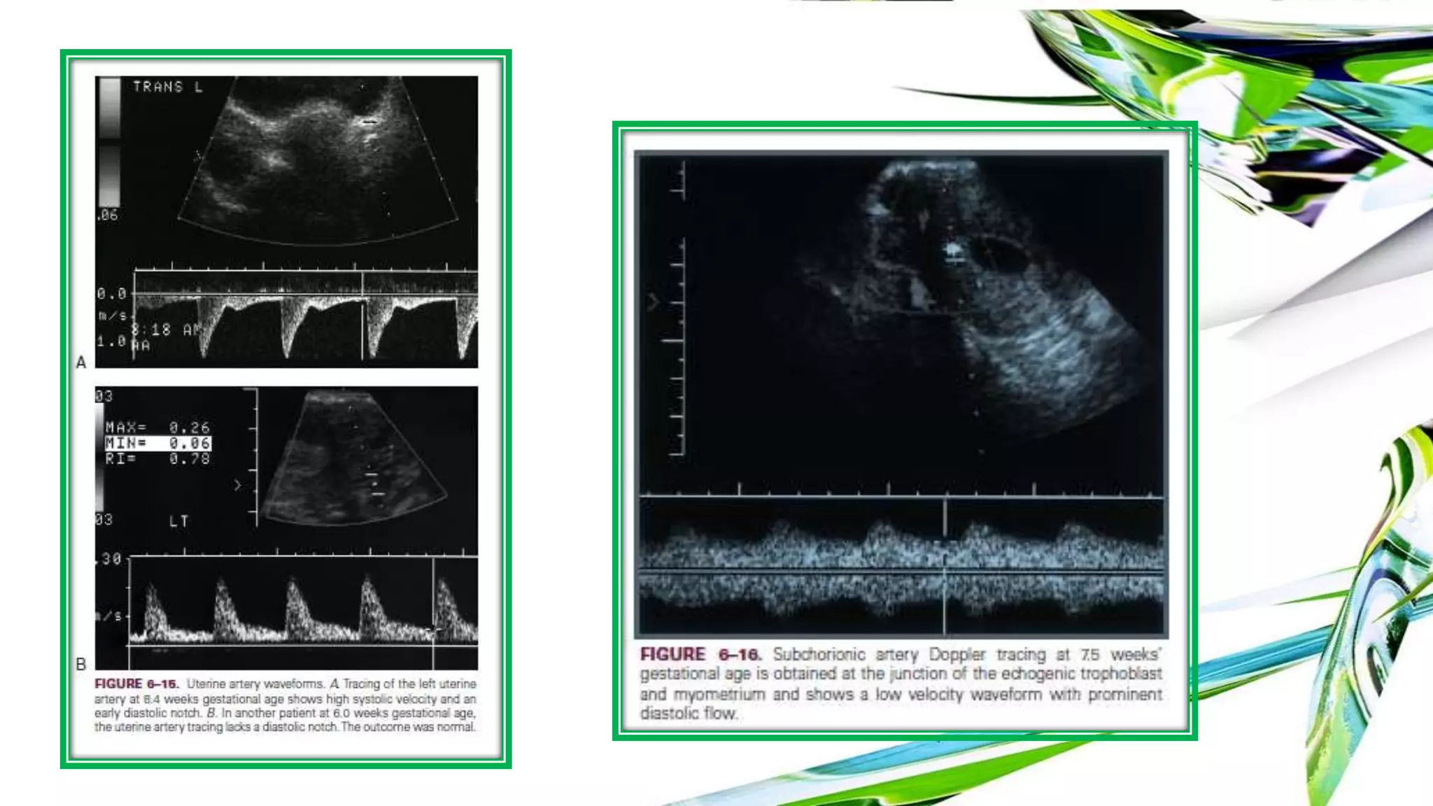 First trimester ultrasound | PPTX