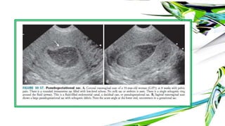 First trimester ultrasound | PPTX