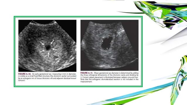 First trimester ultrasound | PPTX