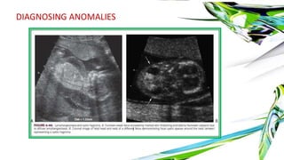 First trimester ultrasound | PPTX