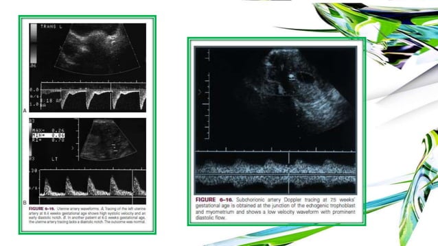 First trimester ultrasound | PPTX