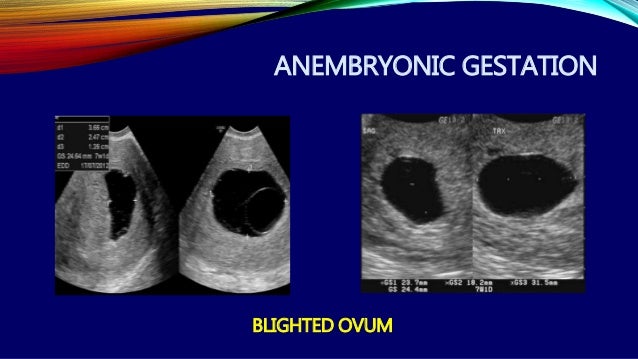 Blighted Ovum Symptoms 8 Weeks