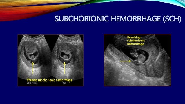 First trimester ultrasound Dr. Muhammad Bin Zulfiqar