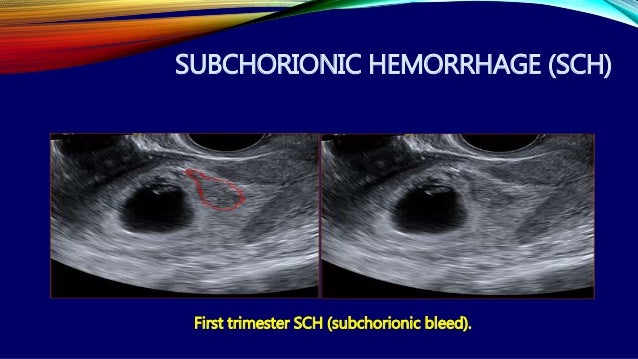 First trimester ultrasound Dr. Muhammad Bin Zulfiqar