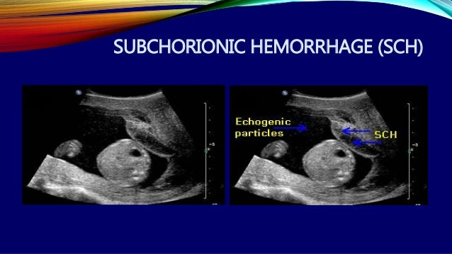First trimester ultrasound Dr. Muhammad Bin Zulfiqar