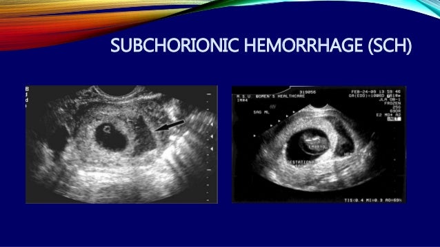First trimester ultrasound Dr. Muhammad Bin Zulfiqar