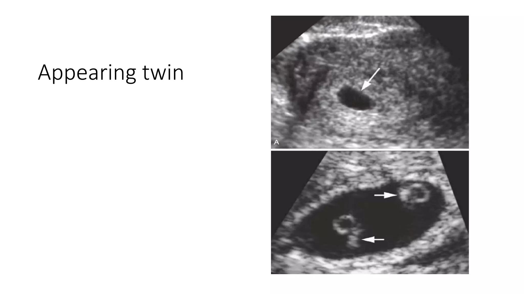 First trimester USG | PPTX