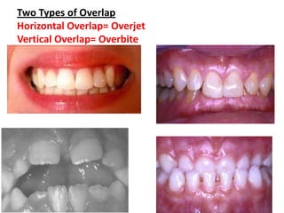 09. Occlusion (Lecture) - Dentition | PPT