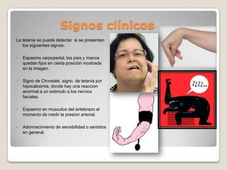 Fisio tetania | PPTX