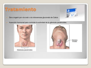 Fisio tetania | PPTX