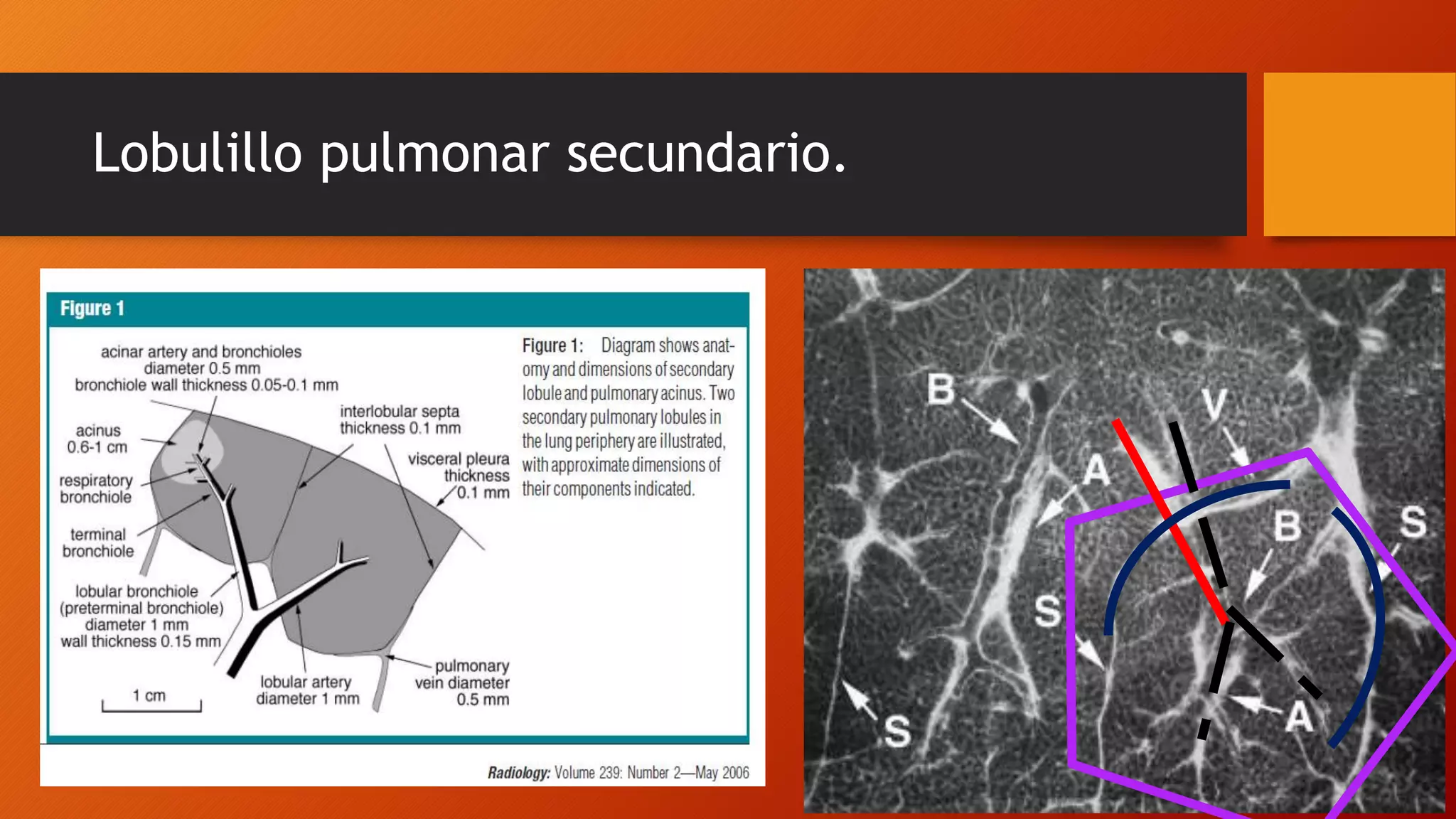 Anatomía Del Lobulillo Pulmonar Secundario